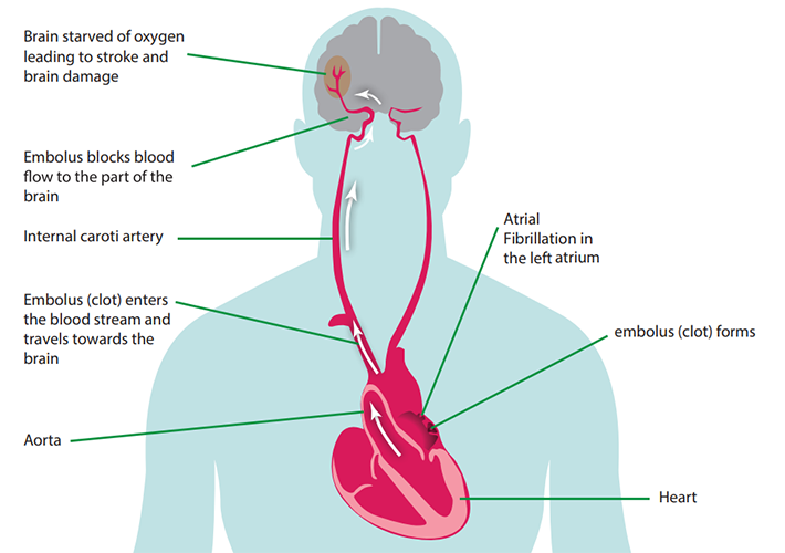 A-Fib - Northern Light Health