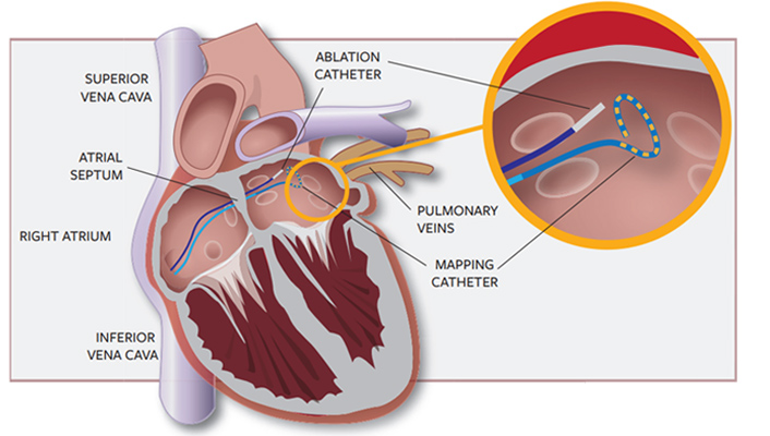 Procedures that may be done - Northern Light Health