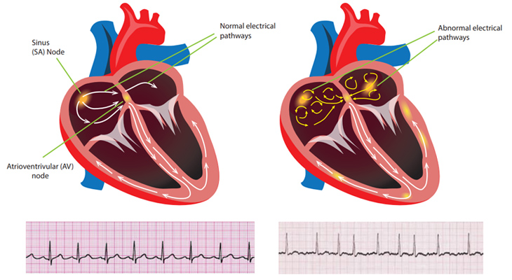 What is Atrial Fibrillation? - Northern Light Health
