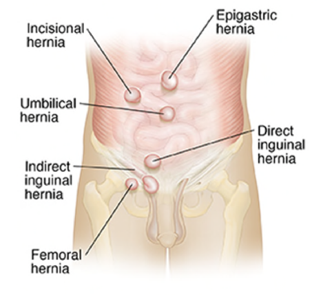 Inguinal Hernia Repair Incision
